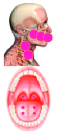 Photobiomodulation Therapy in the Treatment of Oral Mucositis ...